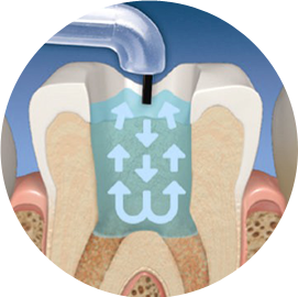 Implant Dentar: Soluția pentru Dinți Pierduți | Best Dental